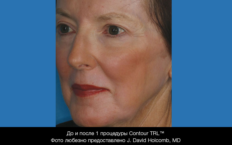 Фото до та після процедур Contour TRL, лазерні шліфування від Sciton.